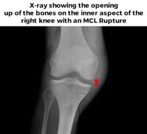 How to Diagnose a Medial Collateral Ligament Injury - IPersonal ...